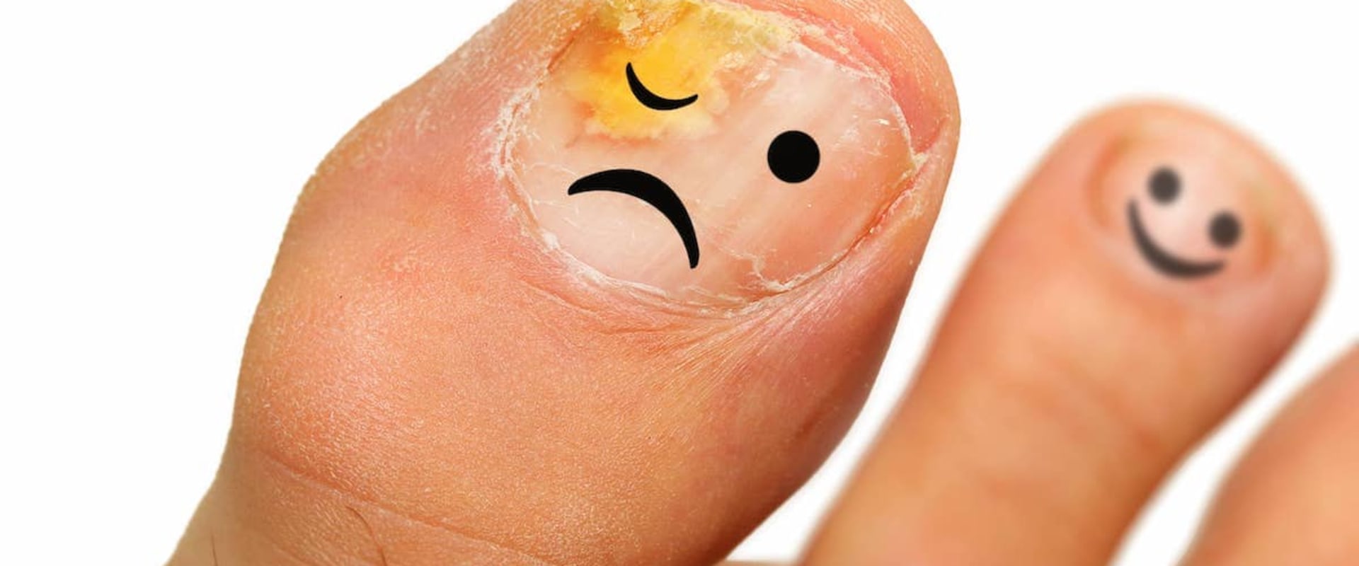 What is the danger of not treating toenail fungus?