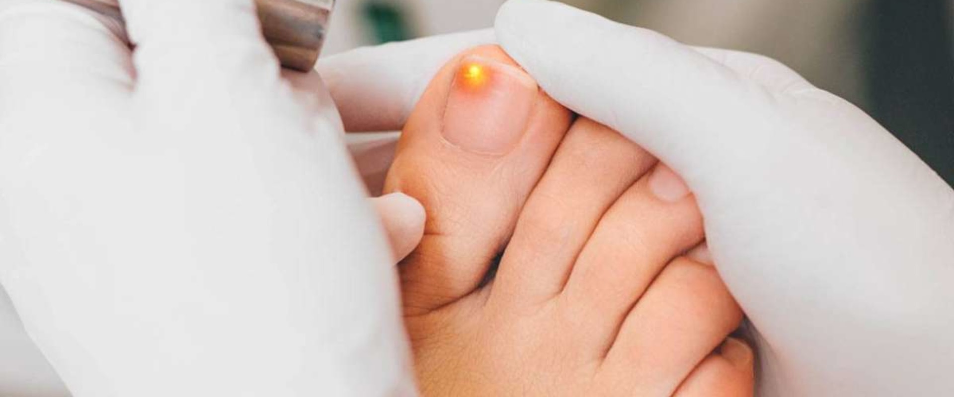 How to Get Rid of Toenail Fungus: A Comprehensive Guide