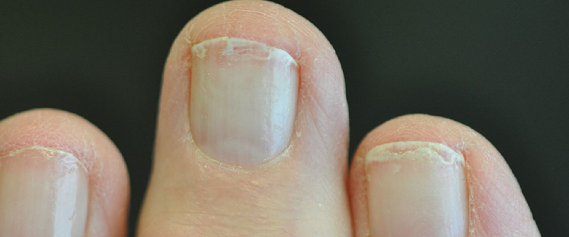 What are 3 signs of a fungal nail infection?